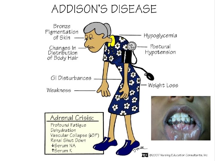 Cushings Addisons and Acromegaly Dr Edward Hutchison FY