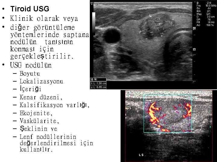 Tiroid Nodlleri ve Tiroid Kanserleri Prof Dr M