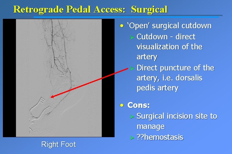 Peripheral Arterial Disease Critical Limb Ischemia Pedal Approach