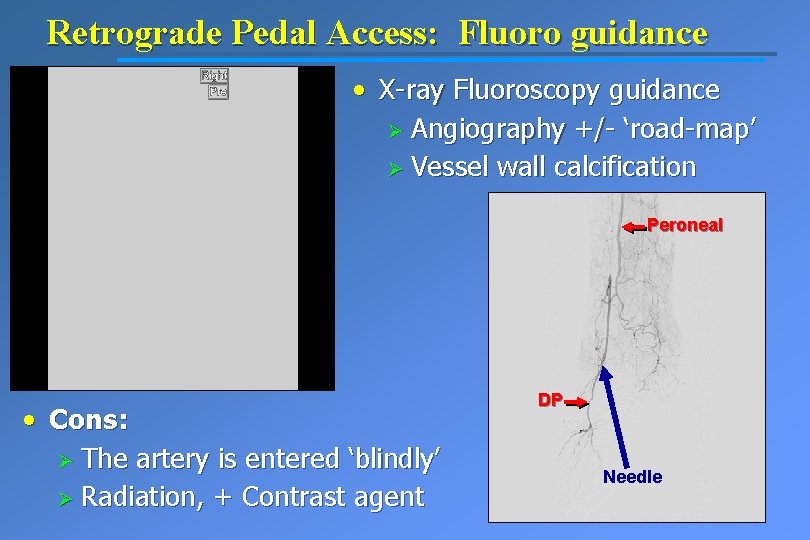 Peripheral Arterial Disease Critical Limb Ischemia Pedal Approach