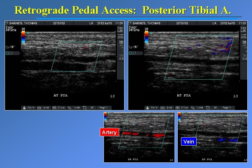 Peripheral Arterial Disease Critical Limb Ischemia Pedal Approach