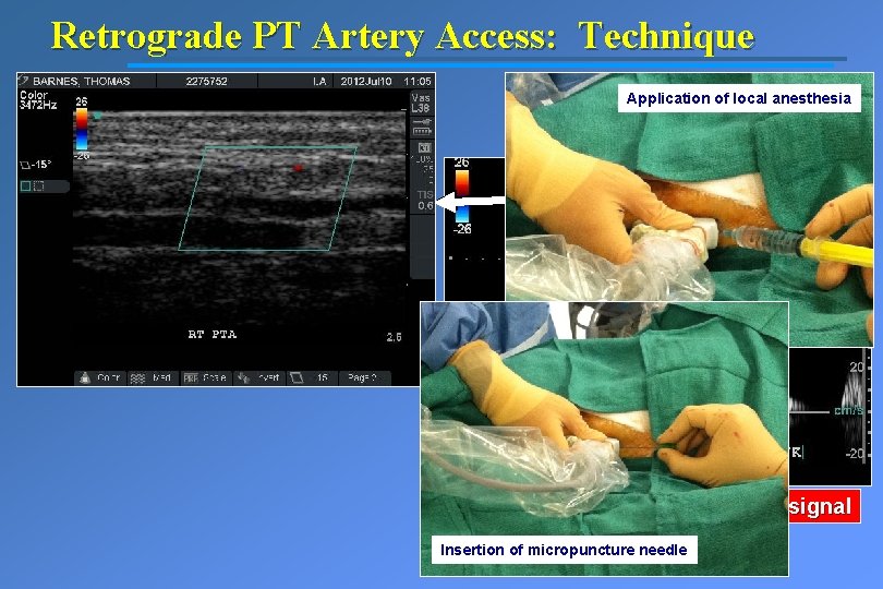Peripheral Arterial Disease Critical Limb Ischemia Pedal Approach