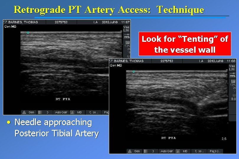 Peripheral Arterial Disease Critical Limb Ischemia Pedal Approach