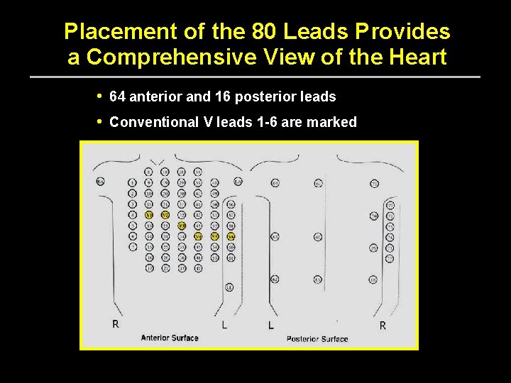 The 80 Lead ECG Body Surface Map Can