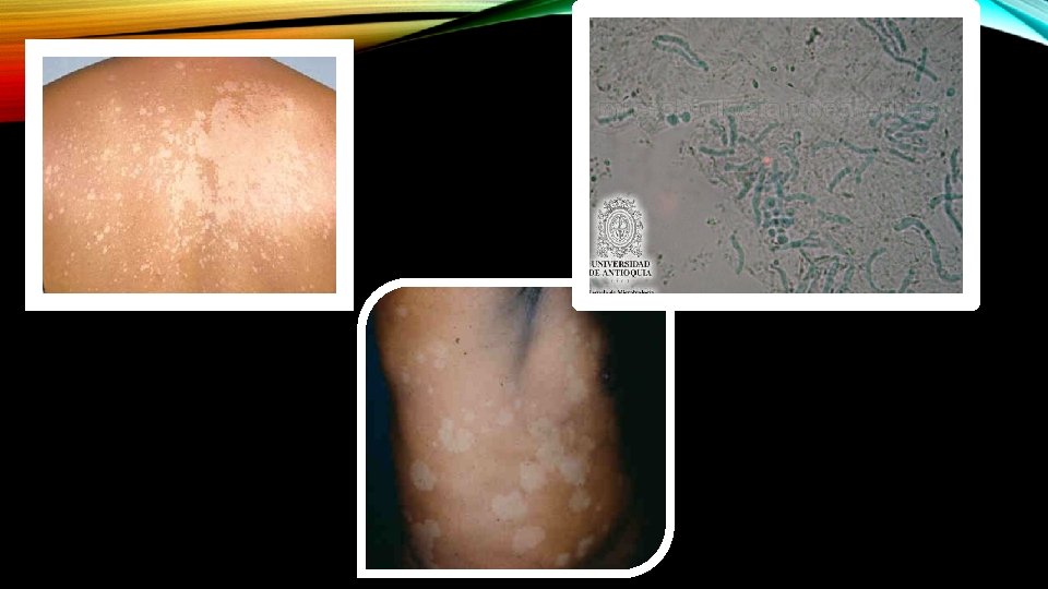 MICOSIS MAS FRECUENTES EN PEDIATRIA Mara Gabriela Samper