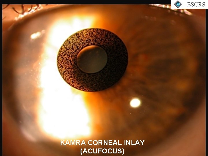 Insructional Course 59 1992011 Intracorneal Inlays for Presbyopia