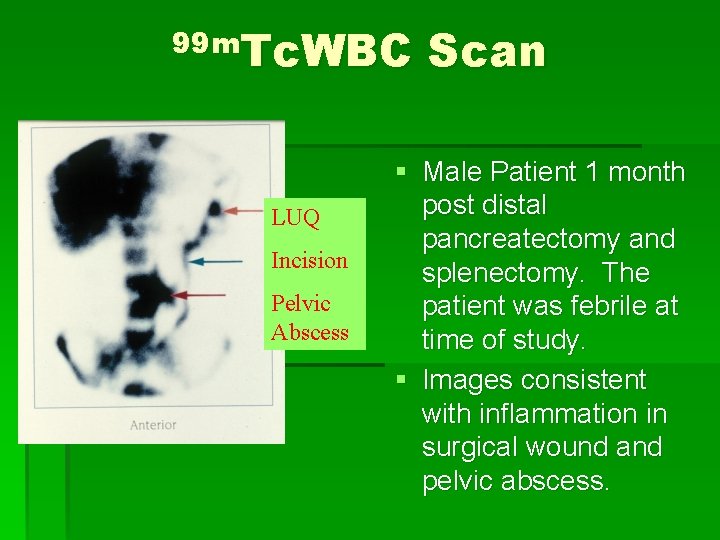 Leukocyte Imaging The Diagnostic Applications of Labeled WBCs