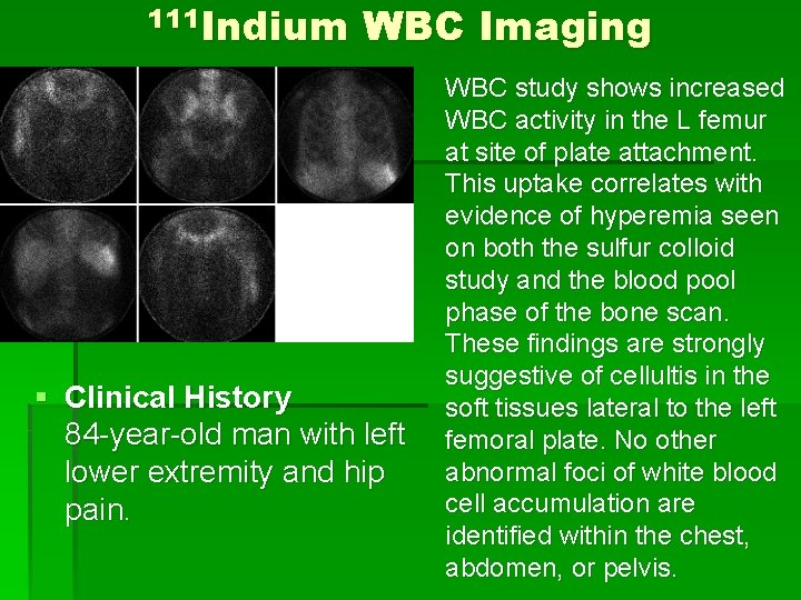 Leukocyte Imaging The Diagnostic Applications of Labeled WBCs