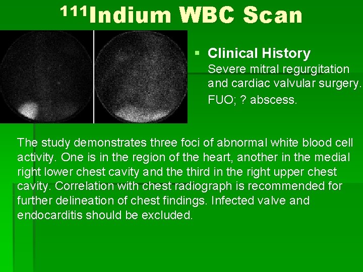 Leukocyte Imaging The Diagnostic Applications of Labeled WBCs