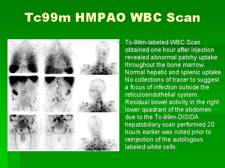 Leukocyte Imaging The Diagnostic Applications of Labeled WBCs
