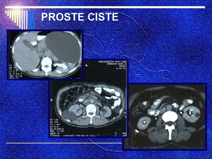 CT U DIJAGNOSTICI OBOLJENJA BUBREGA Prof dr Mira