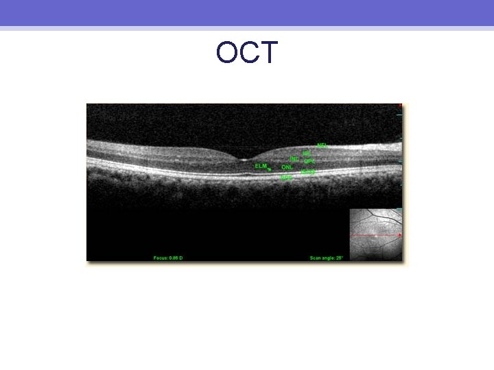 DIABETES AND THE EYE Monika Pradhan Acute Eye