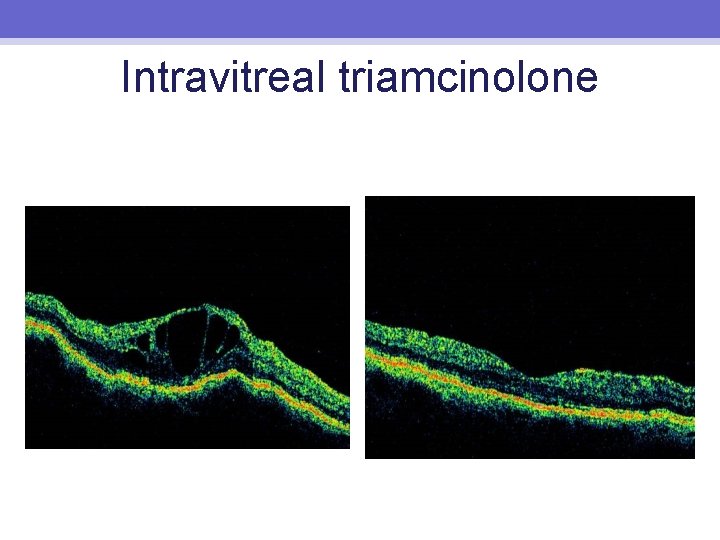 DIABETES AND THE EYE Monika Pradhan Acute Eye
