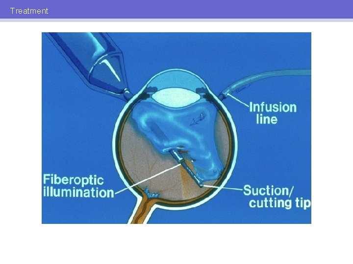 DIABETES AND THE EYE Monika Pradhan Acute Eye