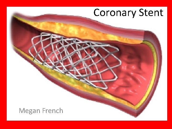 Coronary Stent Megan French What is a Stent