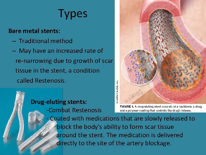 Coronary Stent Megan French What is a Stent