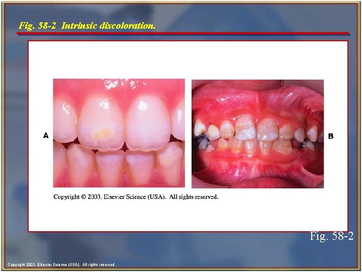Chapter 58 Coronal Polish Copyright 2003 Elsevier Science