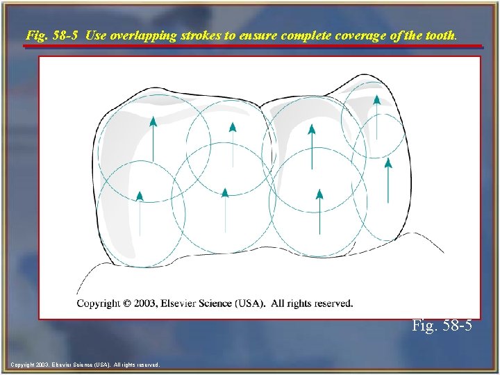 Chapter 58 Coronal Polish Copyright 2003 Elsevier Science