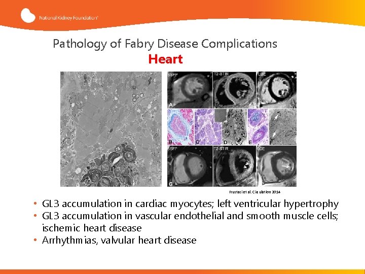 Evaluation and Management of Fabry Disease Supported by