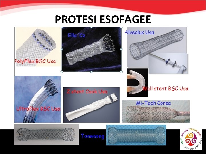 ENDOPROTESI DIGESTIVE applicazioni e gestione Maria Marino Endoprotesi