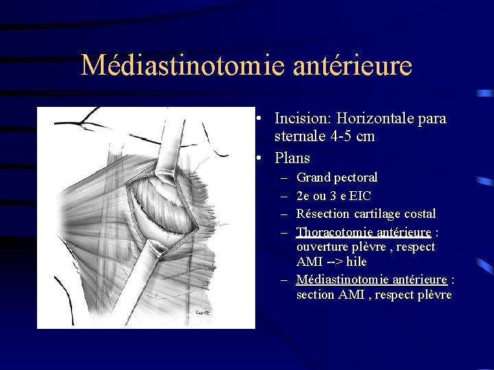 Voies dabord en Chirurgie Thoracique Dr KARSENTI Hpital