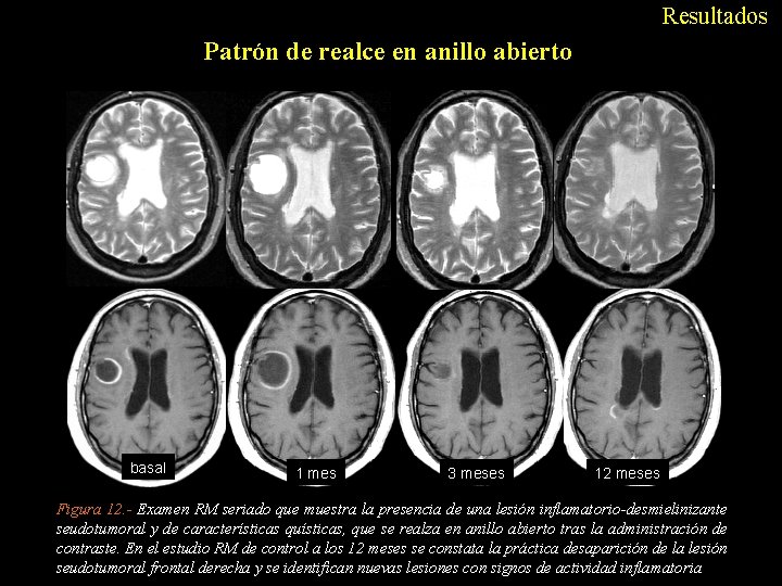 Lesiones inflamatoriodesmielinizantes Hallazgos clnicoradiolgicos R ...