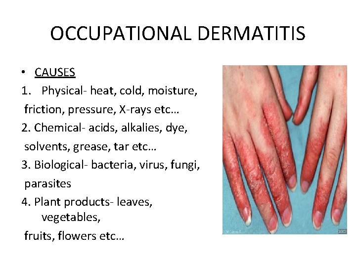 OCCUPATIONAL DISEASE Dr Reshma Reghu Lecturer Dept of