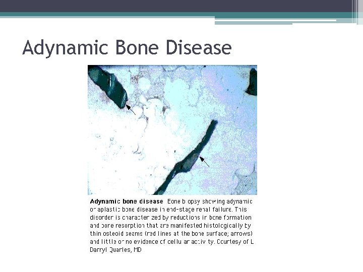 Spectrum of Metabolic Bone Diseases in CKD Pathogenesis