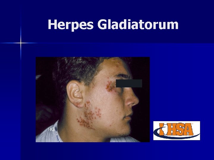 Common skin conditions in wrestling Ringworm Impetigo Mulluscum