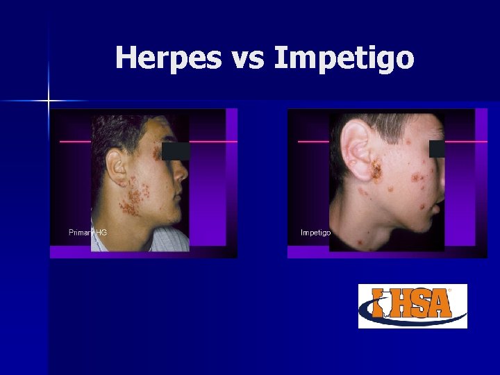 Common skin conditions in wrestling Ringworm Impetigo Mulluscum