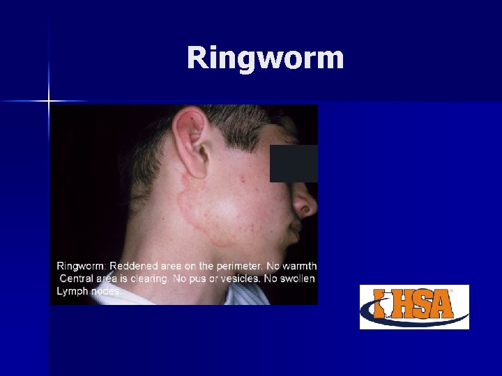 Common skin conditions in wrestling Ringworm Impetigo Mulluscum