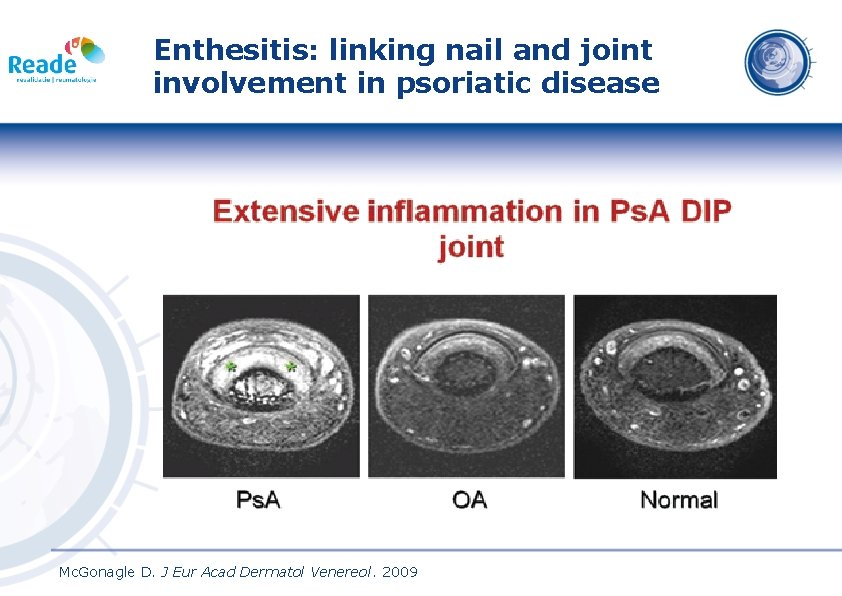 Tendinitis en enthesitis in artritis psoriatica Een rol