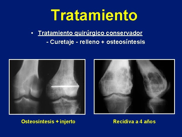 Condroblastoma Benigno Condroblastoma Benigno Tumor cartilaginoso ...