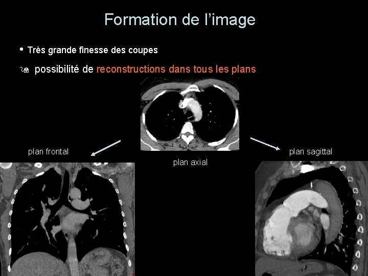 SCANNER THORACIQUE NORMAL MariePierre Debray Nicoletta Pasi Yal