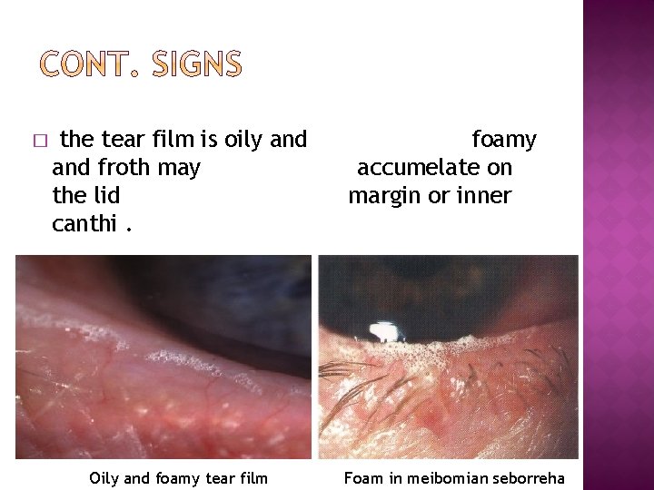Mahmood J Showail Blepharitis is inflammation or infection