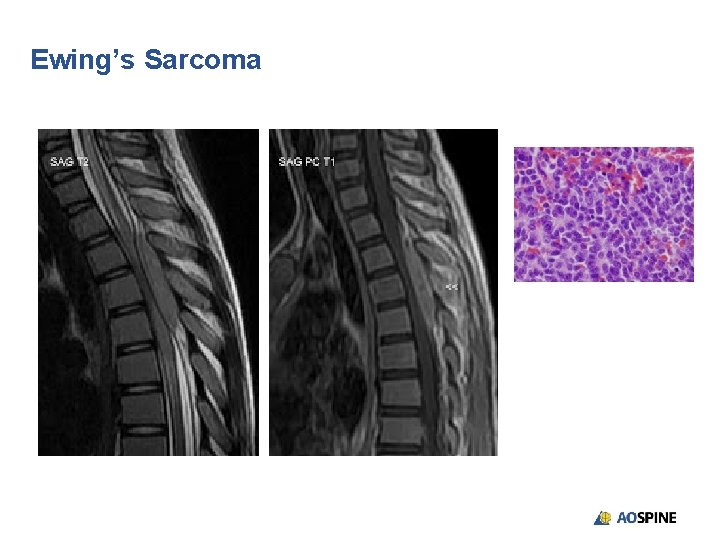 Primary spinal tumors Assessment prognostic factors and management