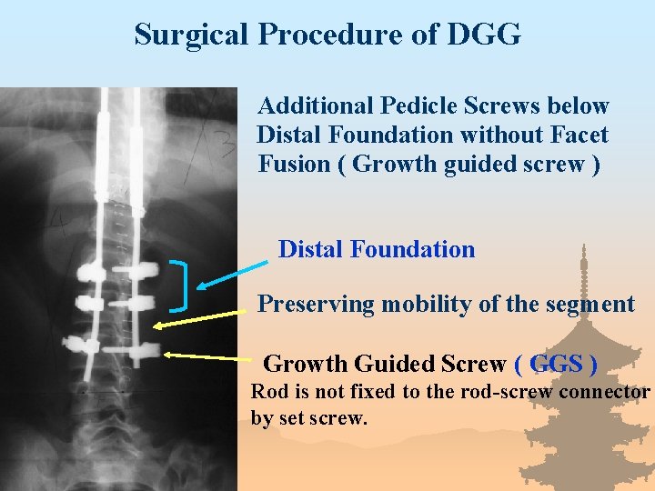 DistractionGrowth Guided Technique DGG for Lumbar Curve Deformity