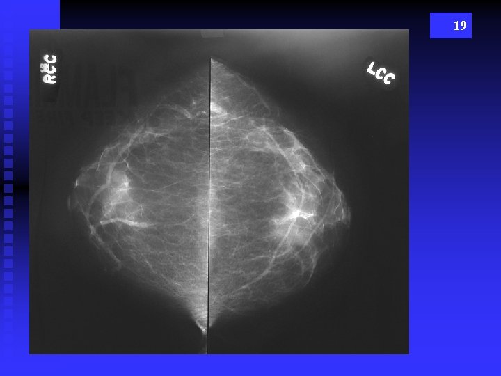 MAMMOGRAPHY LECTURE 1 rev 2010 Positioning Anatomy RADIOGRAPHIC