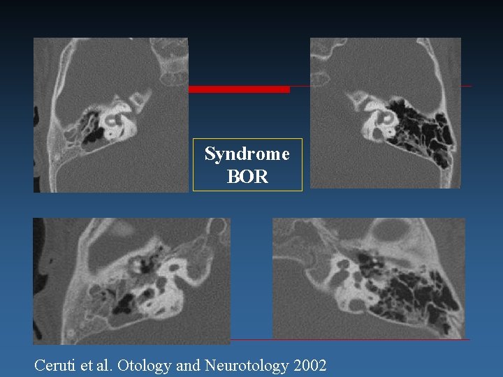 Master de Neuroimagerie Diagnostique Sousse avril 2008 SURDITS