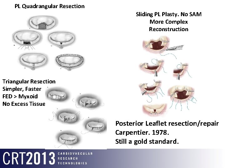 Current surgical standards for mitral leaflet or chordal
