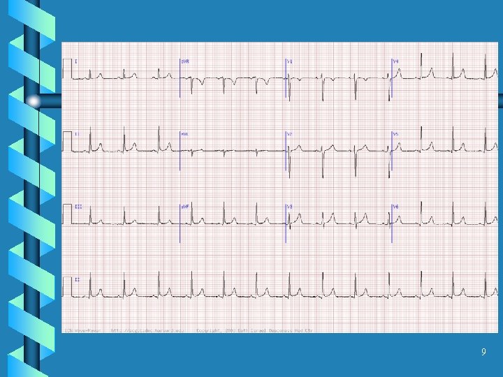 MAKING ECGS EASY EVALUATING THE ECG Dr Nick