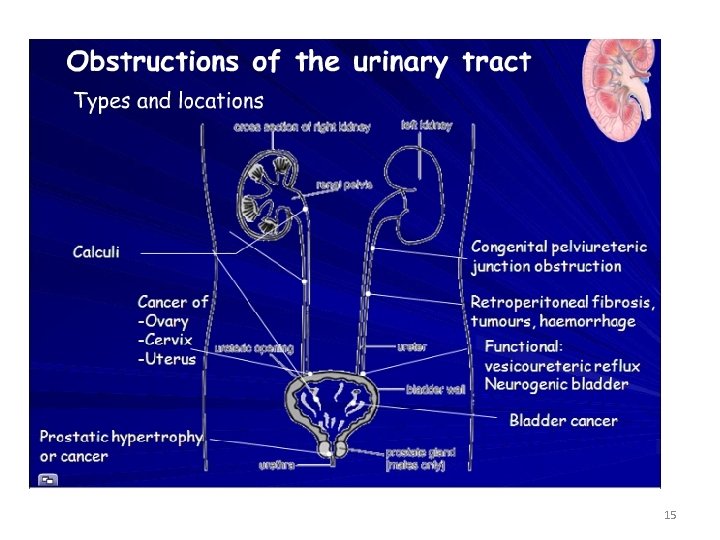 Urology 4 Hydronephrosis Contents Definition Etiology Pathology Clinical