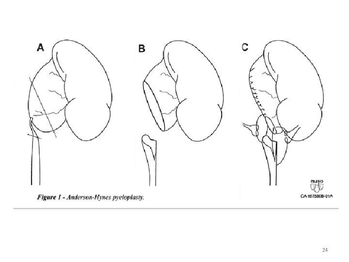 Urology 4 Hydronephrosis Contents Definition Etiology Pathology Clinical