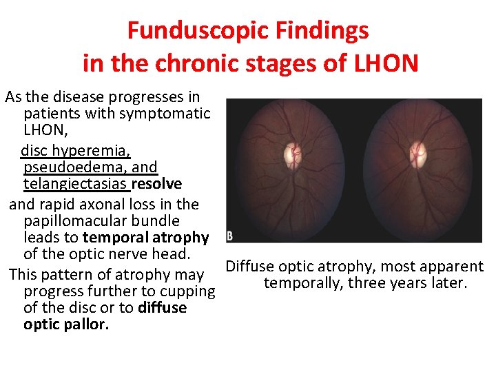 Leber hereditary optic neuropathy LHON By Dr Bita