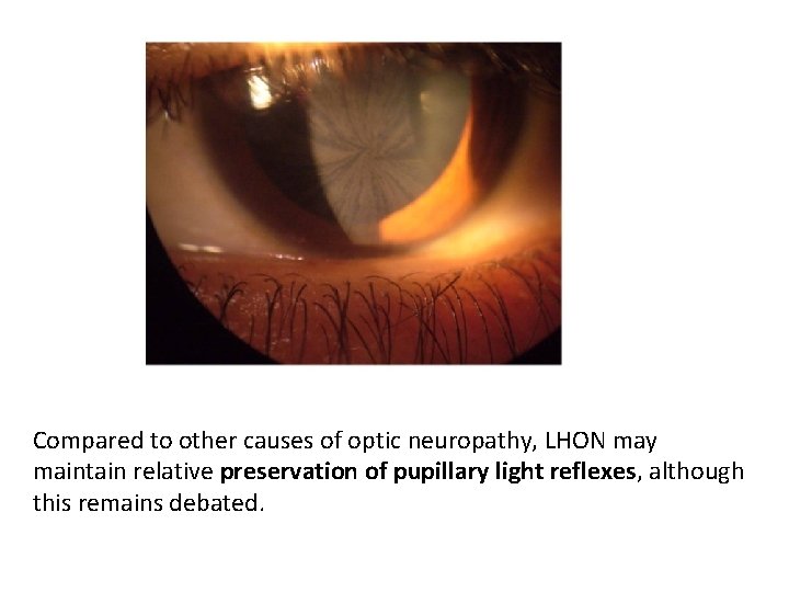 Leber hereditary optic neuropathy LHON By Dr Bita