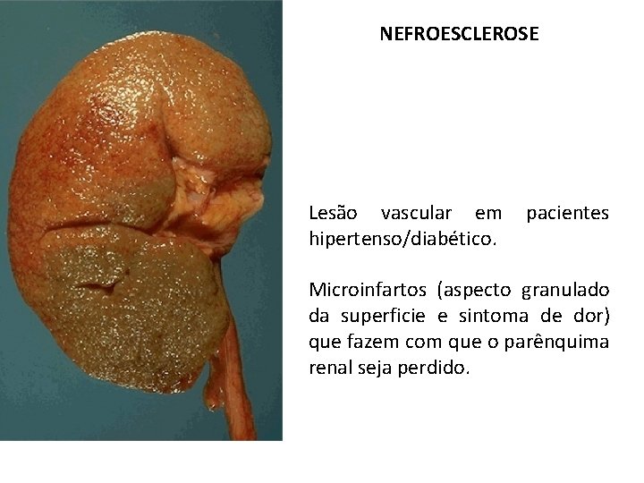 Doenas Renais No Obstrutivas TC corte coronal Infarto