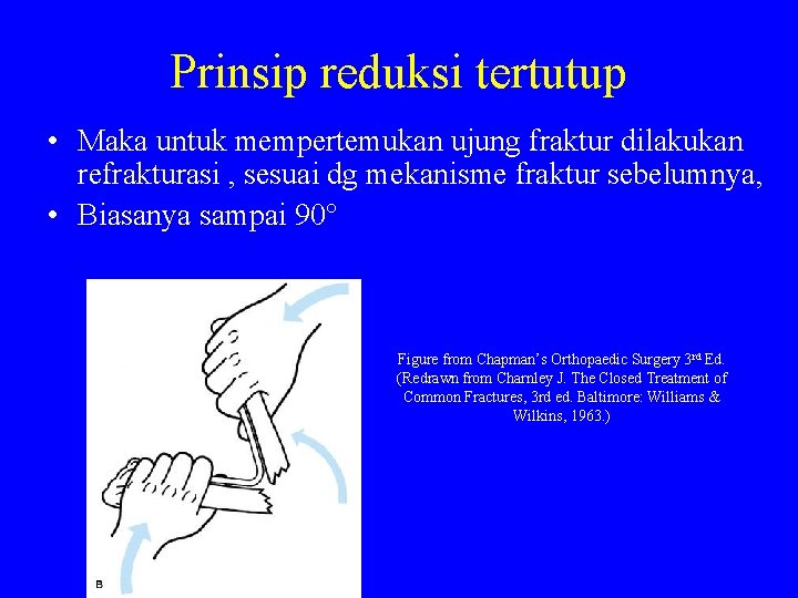 Reduksi Tertutup Tehnik Traksi Bidai dan Casting Dr