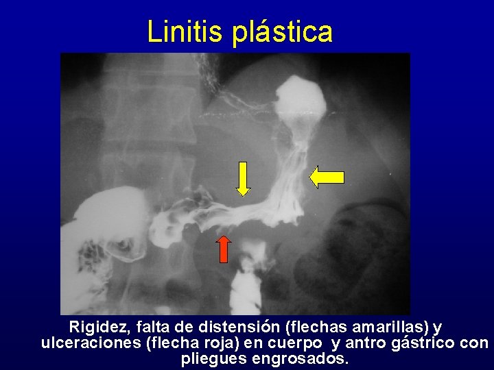 La radiologa en el Cncer Gstrico Escirro Dr