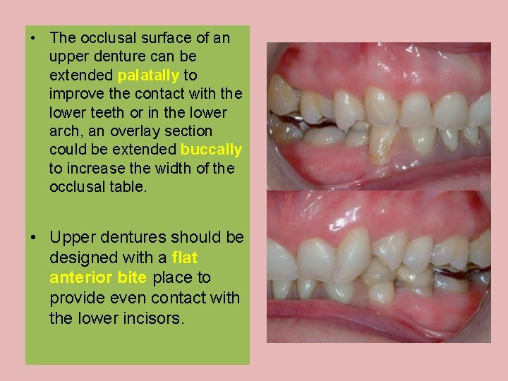 Restorative Management of Deep over bite introduction overbite