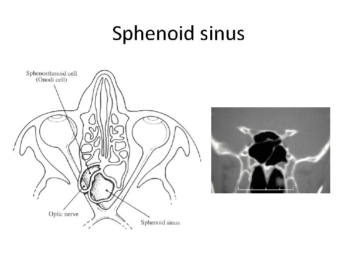 Radiology of Nasal Cavity and Paranasal Sinuses Radiology